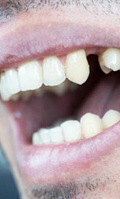 Tooth Replacement Service from Northlane Dental Practice